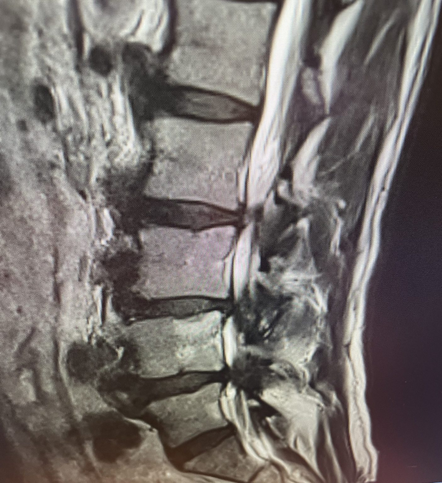 Lateral Recess Stenosis | NSPC Brain & Spine Surgery